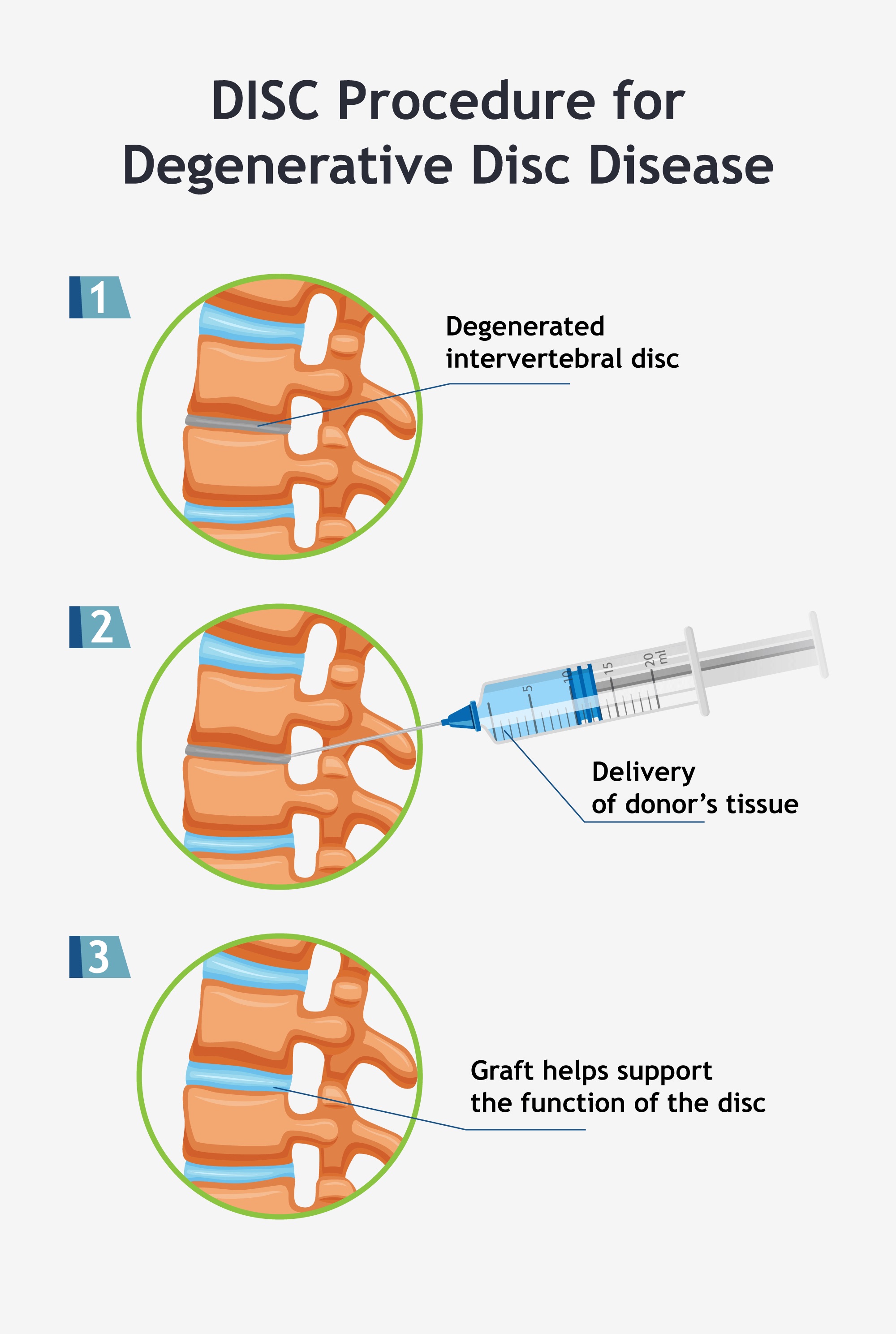 DISC Procedure | Advanced Spine and Pain