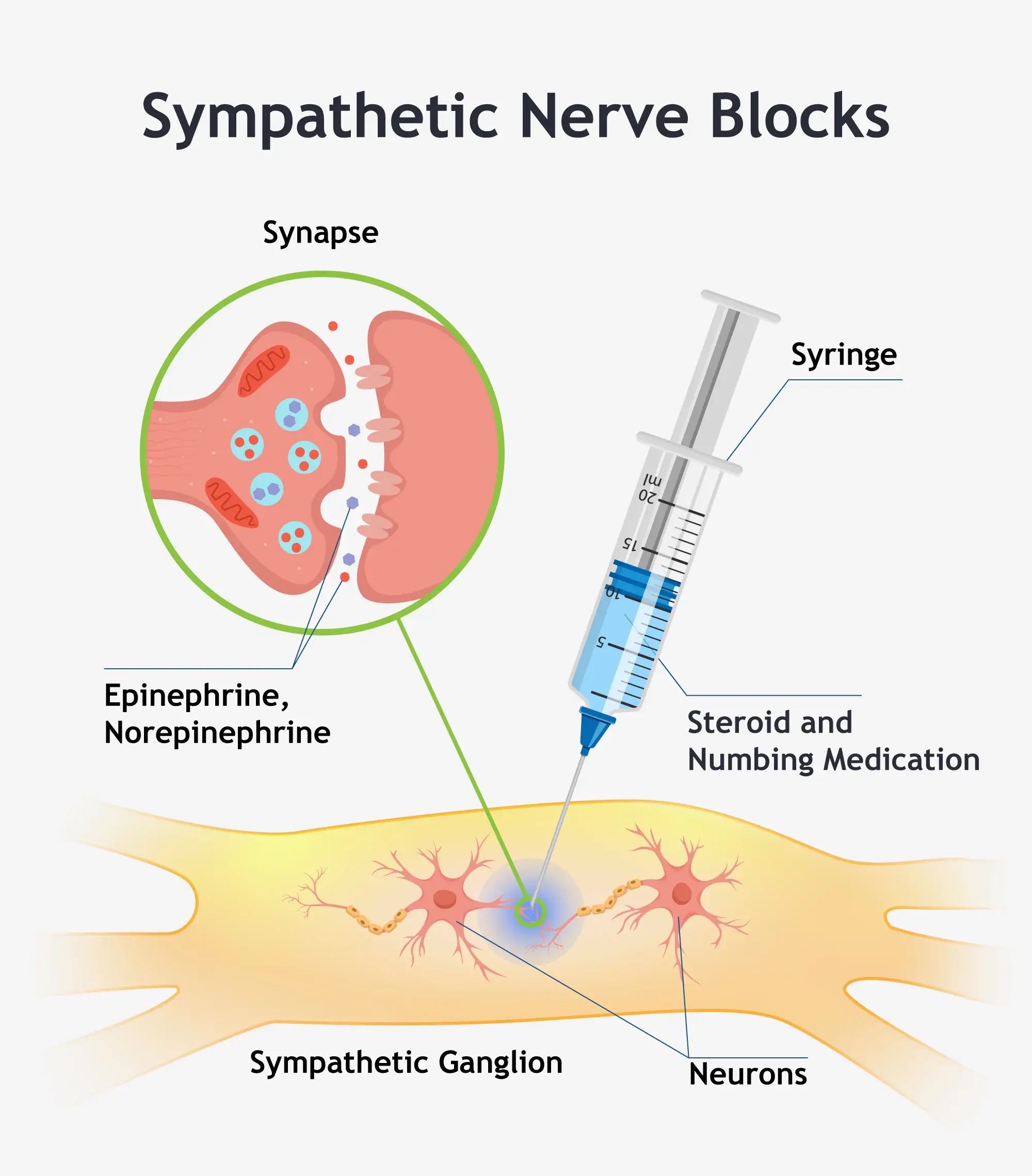 Sympathetic Nerve Blocks | Advanced Spine and Pain