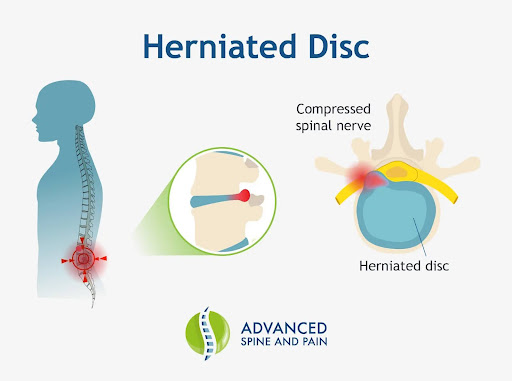 Do Bulging Discs Heal? | Advanced Spine and Pain