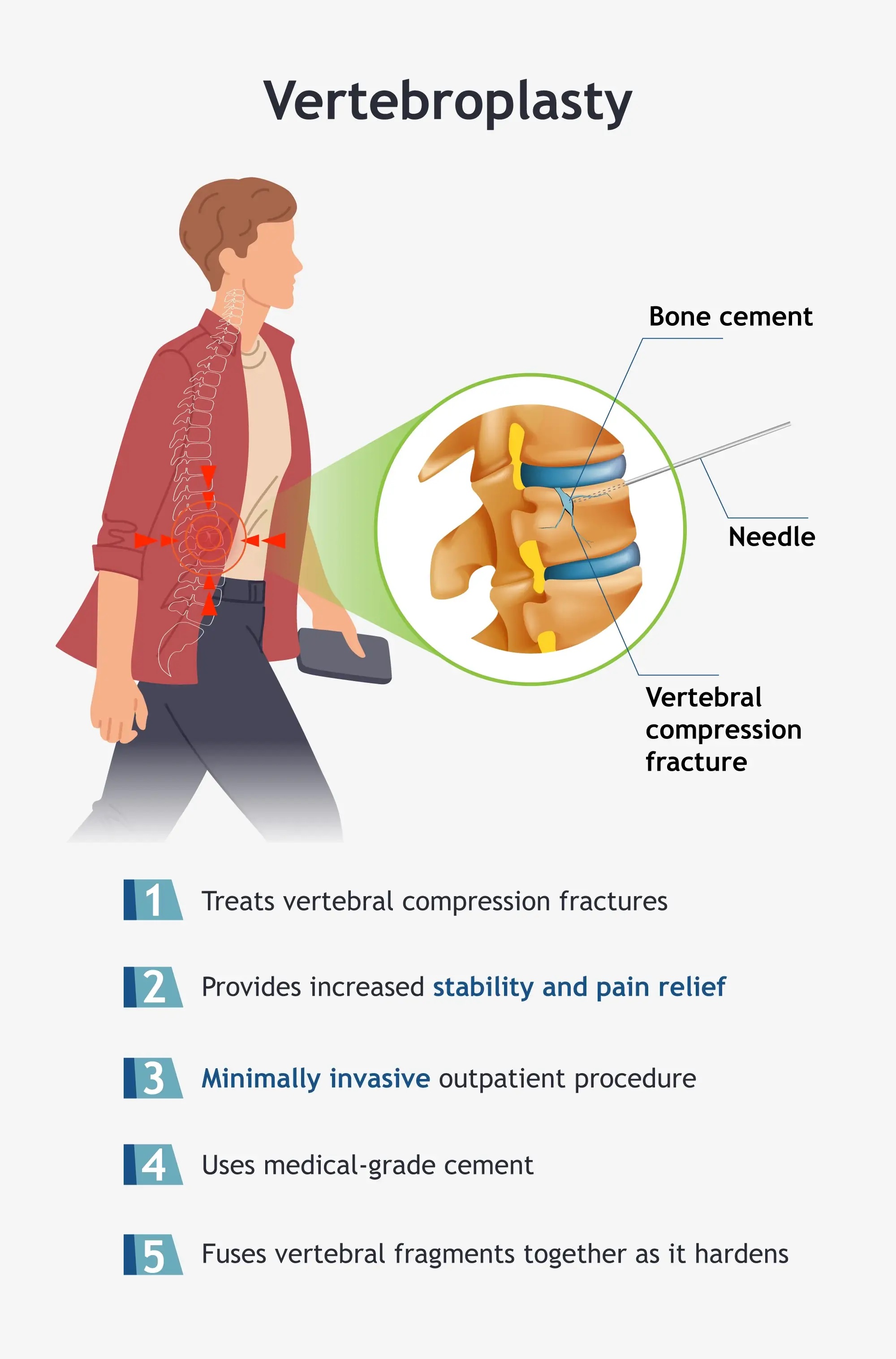 Vertebroplasty | Advanced Spine and Pain